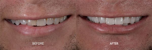 How Much Are Dental Veneers in Mexico? Cancun Dental Veneers 2021