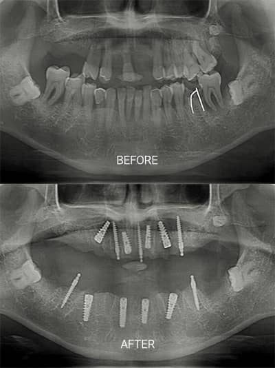 Dental Implants Xray