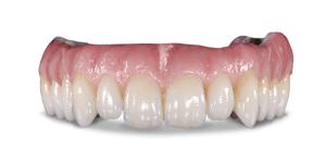 All on 4 Dental Implants in Mexico - Cancun Dental Specialists