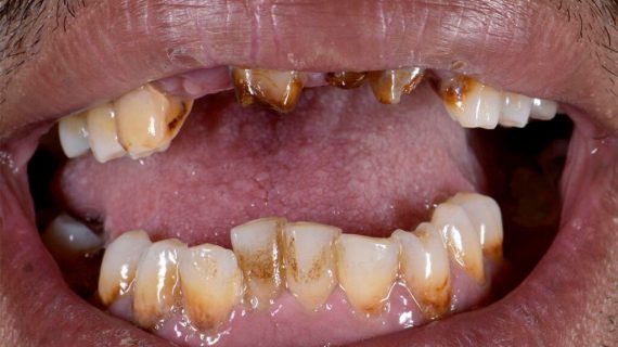 Full Mouth Reconstruction ⋆ Cancun Dental Specialists